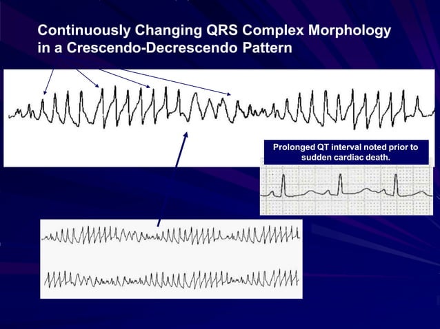 BASIC ECG RTHYM RAJI.pptx ACLS PREPARATION | PPT