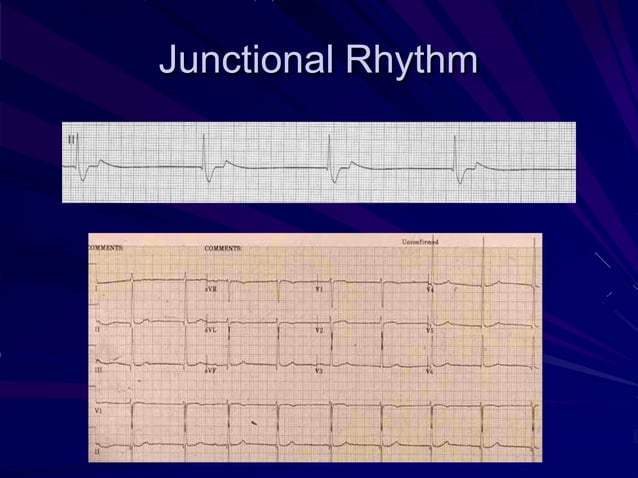 BASIC ECG RTHYM RAJI.pptx ACLS PREPARATION | PPT