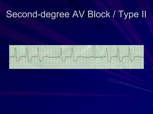 BASIC ECG RTHYM RAJI.pptx ACLS PREPARATION | PPT
