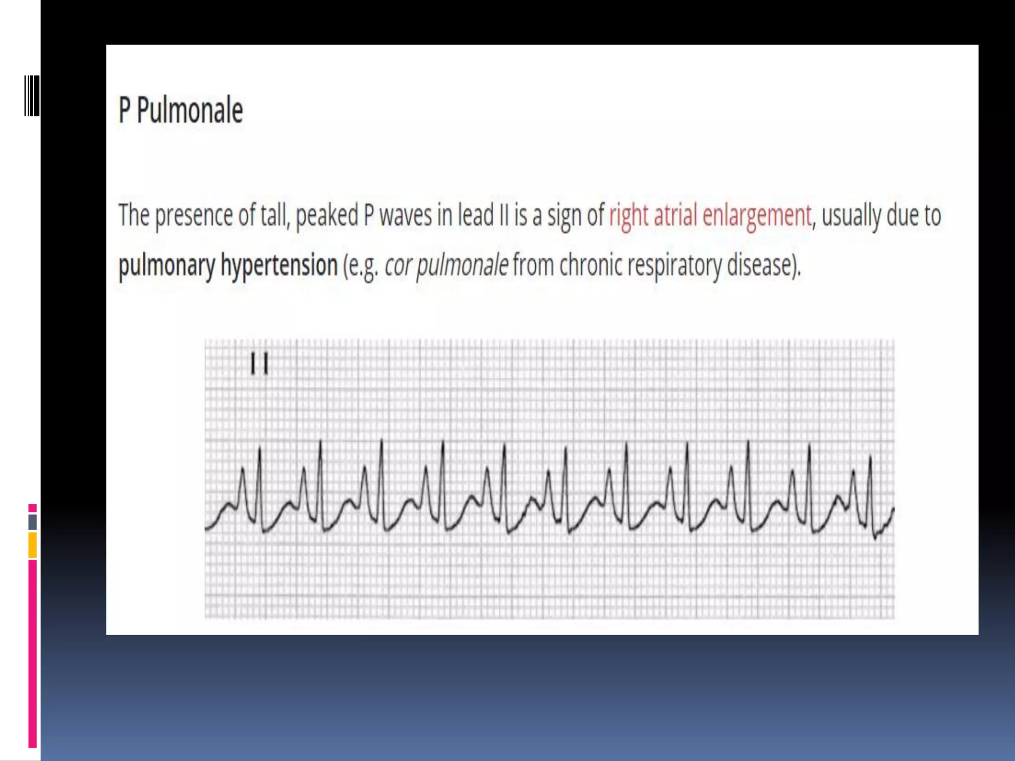 Basic ECG &rhythm interpretation | PDF