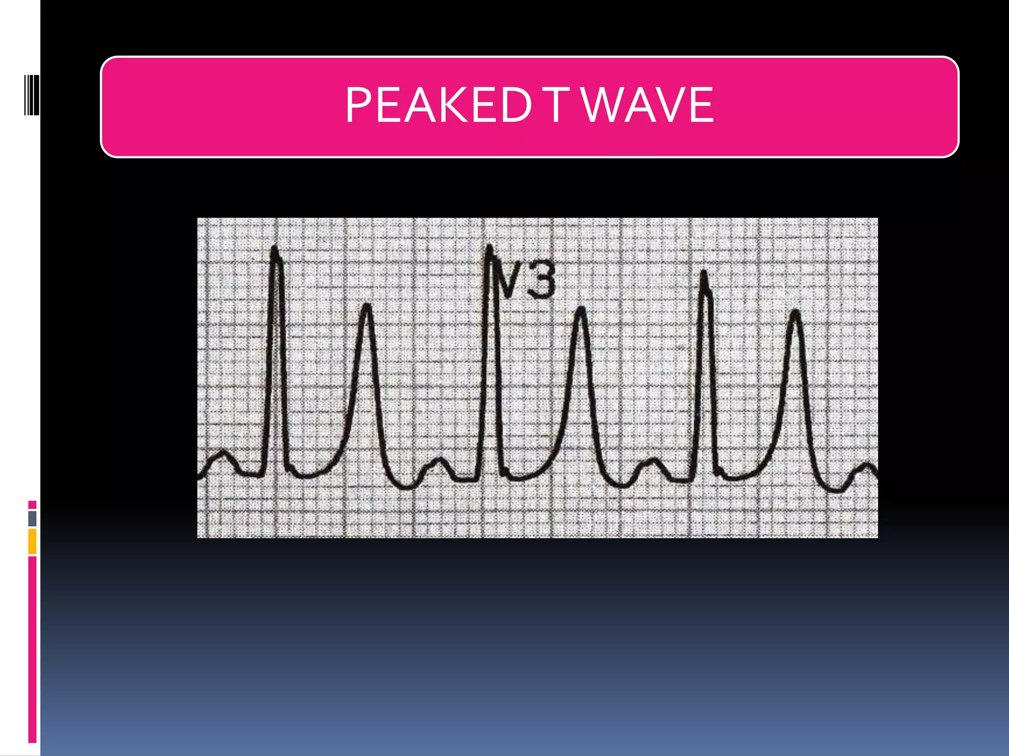 Basic ECG &rhythm interpretation | PDF