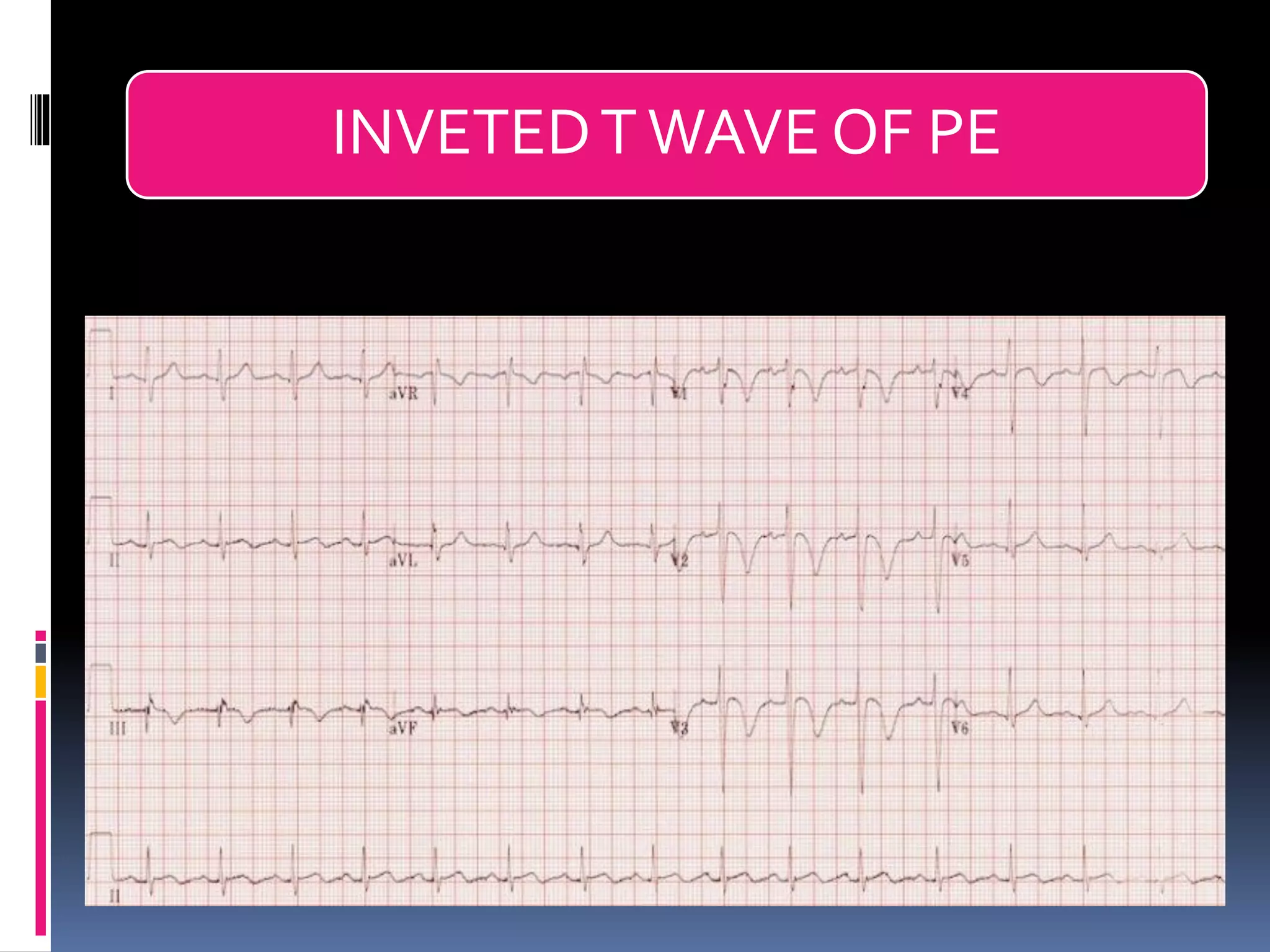 Basic ECG &rhythm interpretation | PDF