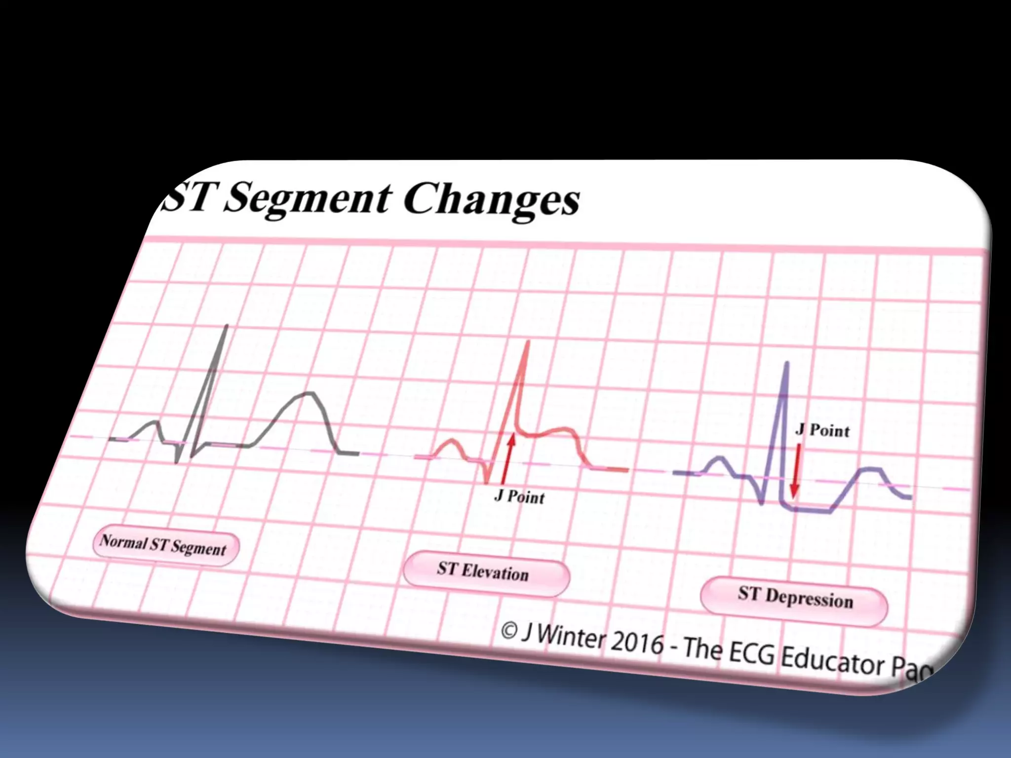 Basic ECG &rhythm interpretation | PDF