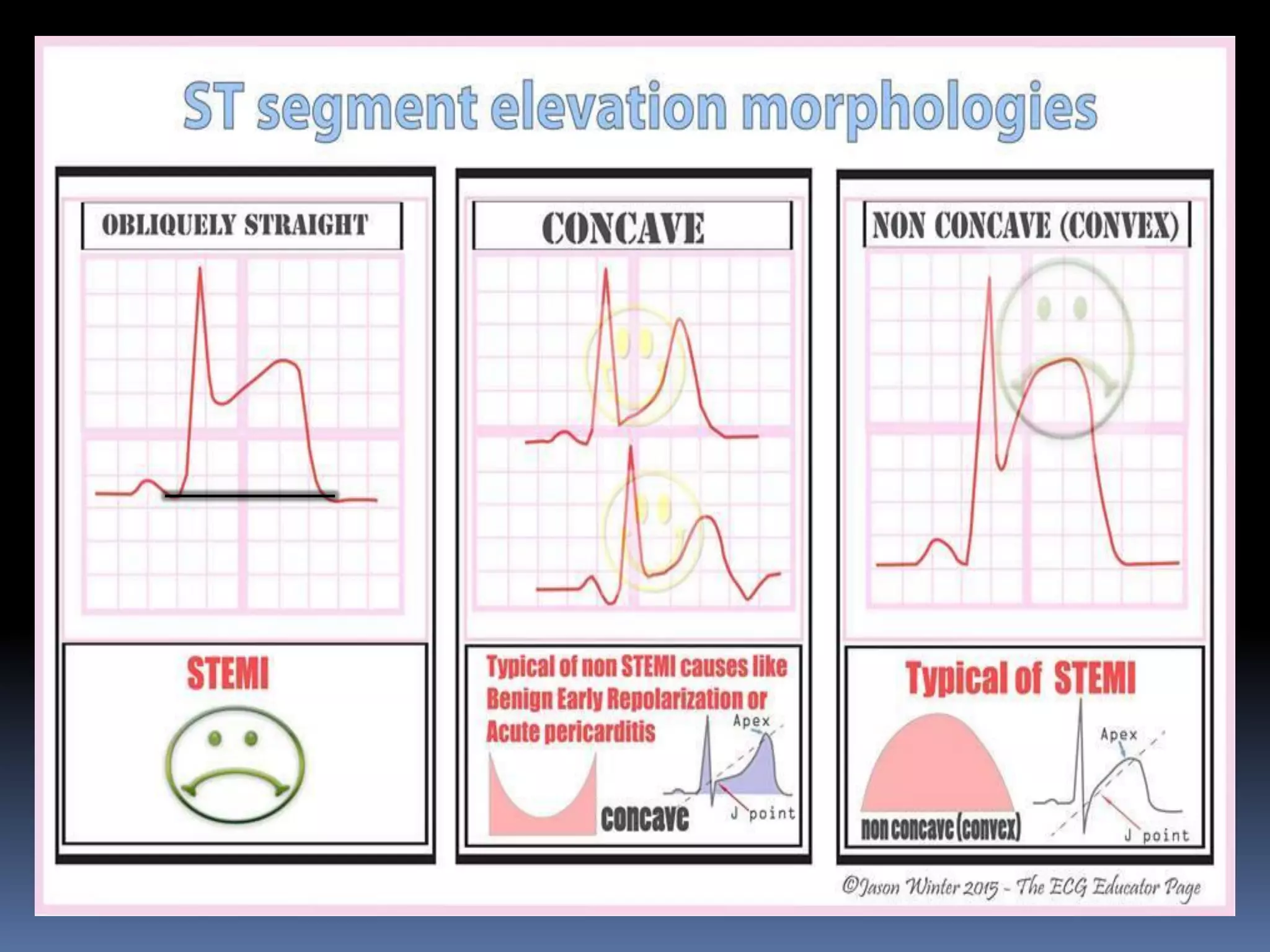 Basic ECG &rhythm interpretation | PDF