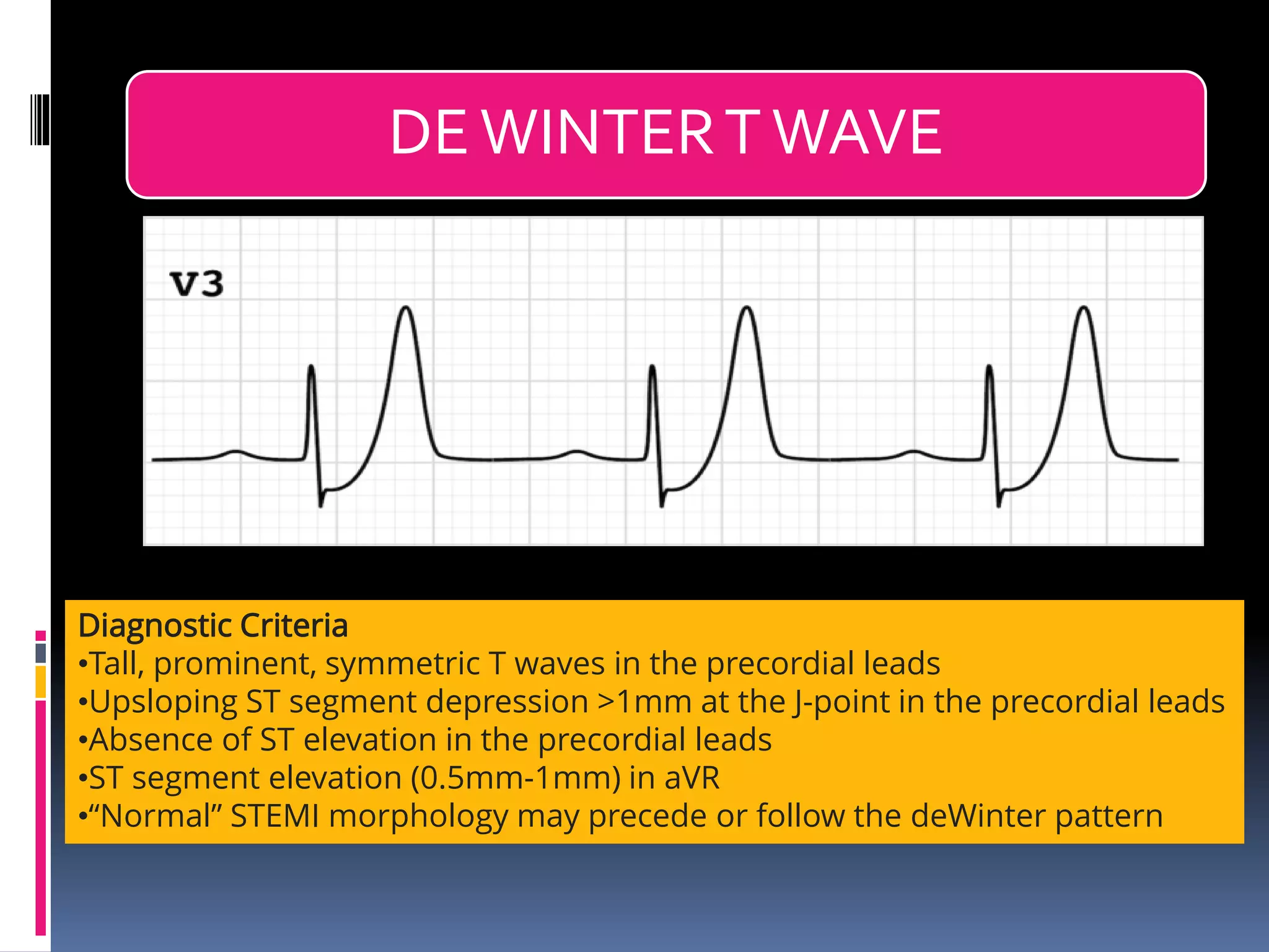 Basic ECG &rhythm interpretation | PDF