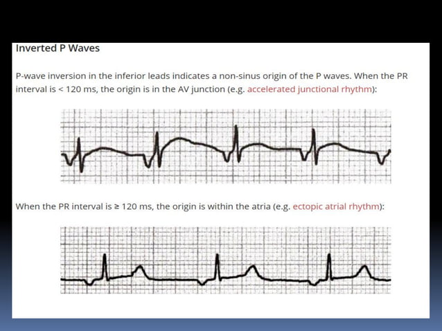 Basic ECG &rhythm interpretation | PDF