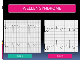 Basic ECG &rhythm interpretation | PDF