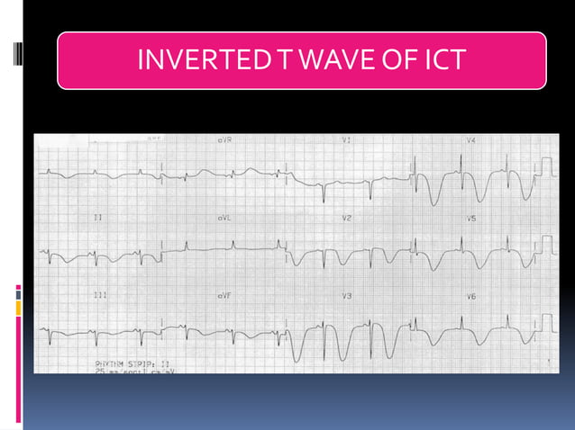 Basic ECG &rhythm interpretation | PDF