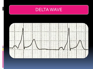 Basic ECG &rhythm interpretation | PDF