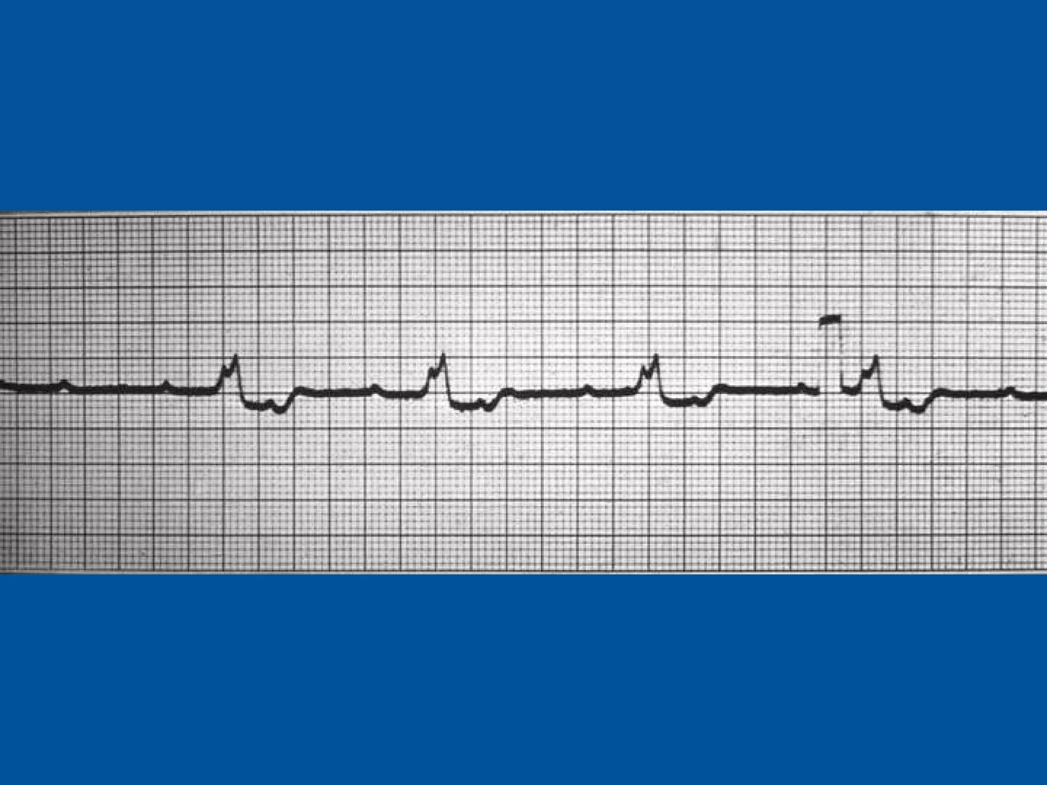 Basic ecg stripsnew | PPT