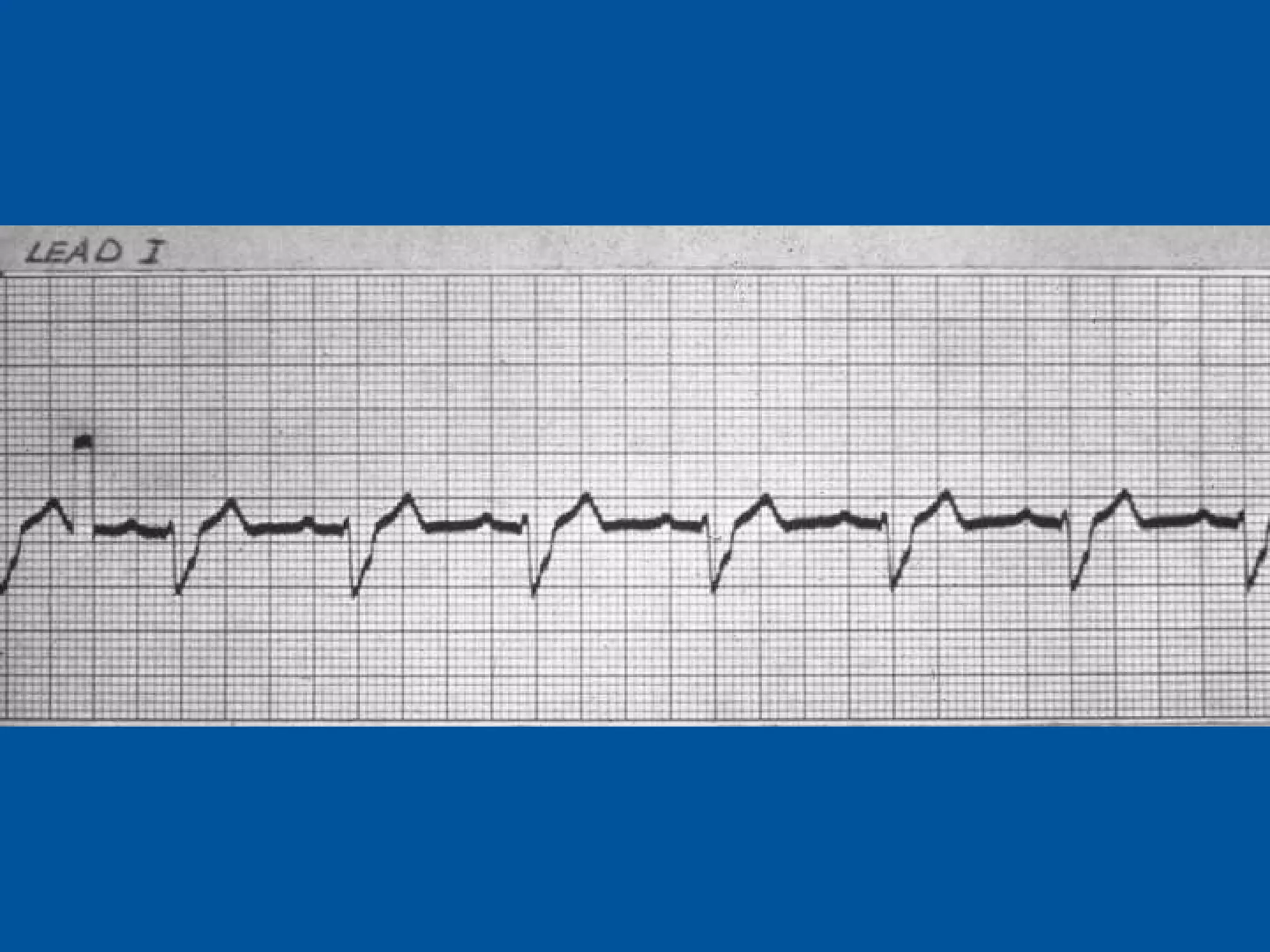 Basic ecg stripsnew | PPT