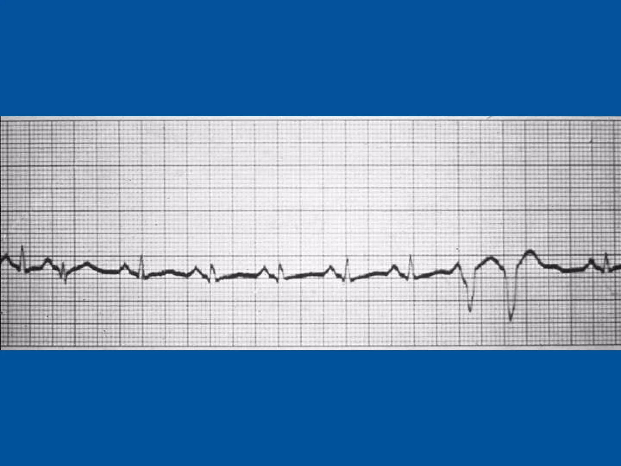 Basic ecg stripsnew | PPT