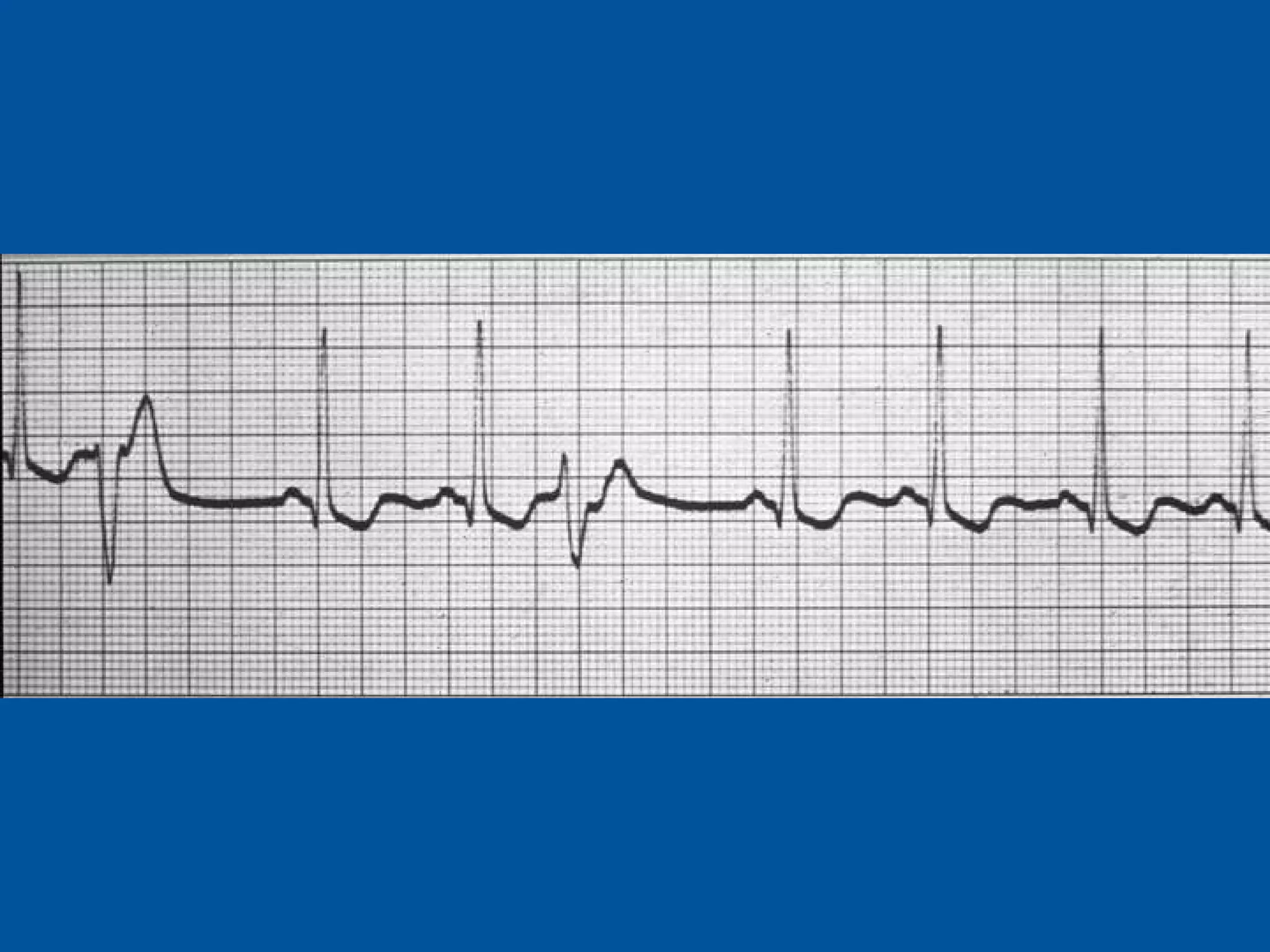 Basic ecg stripsnew | PPT