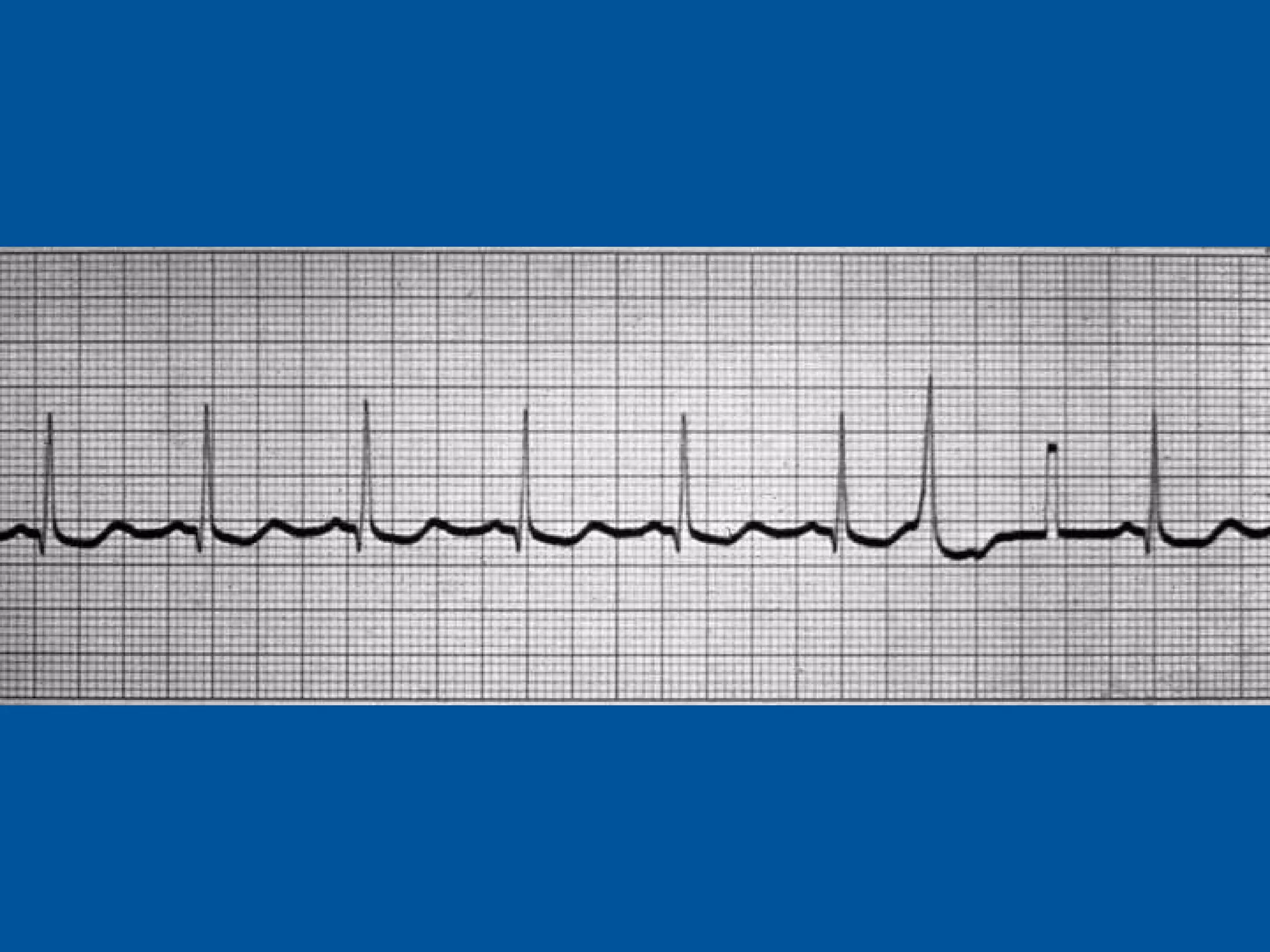 Basic ecg stripsnew | PPT