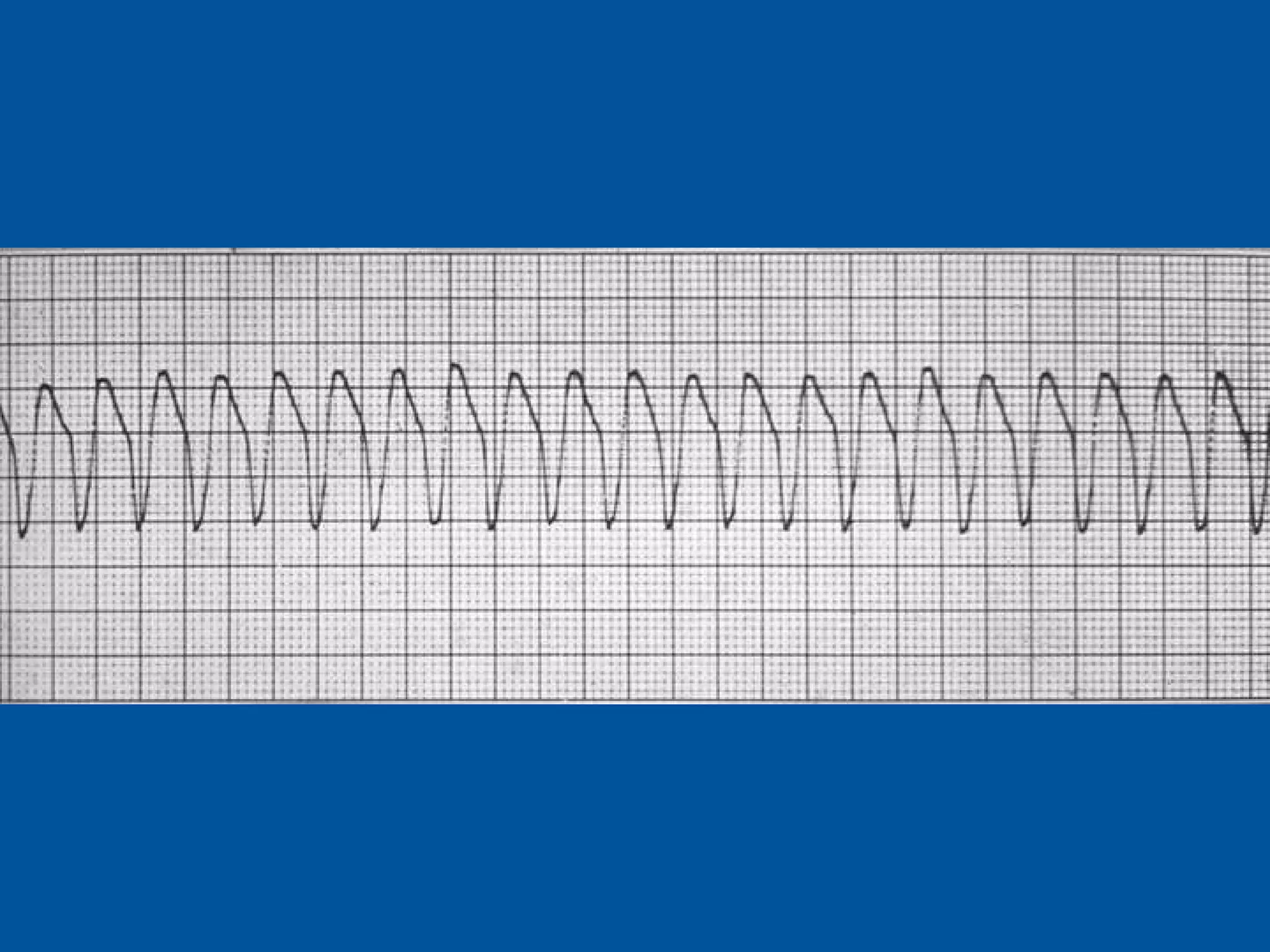 Basic ecg stripsnew | PPT