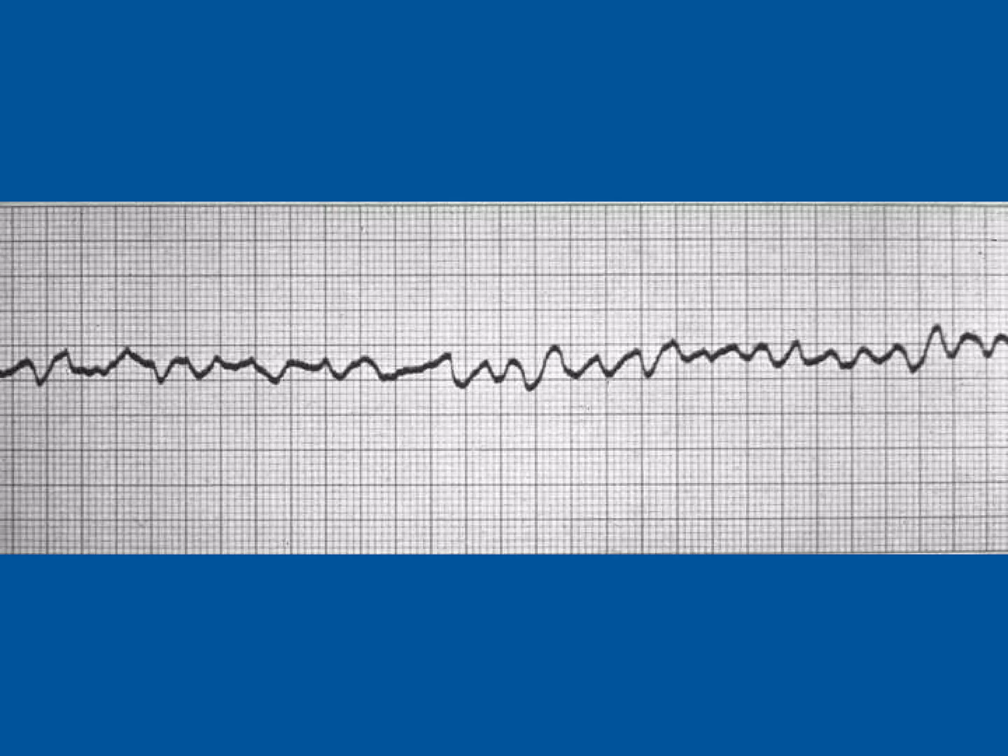 Basic ecg stripsnew | PPT