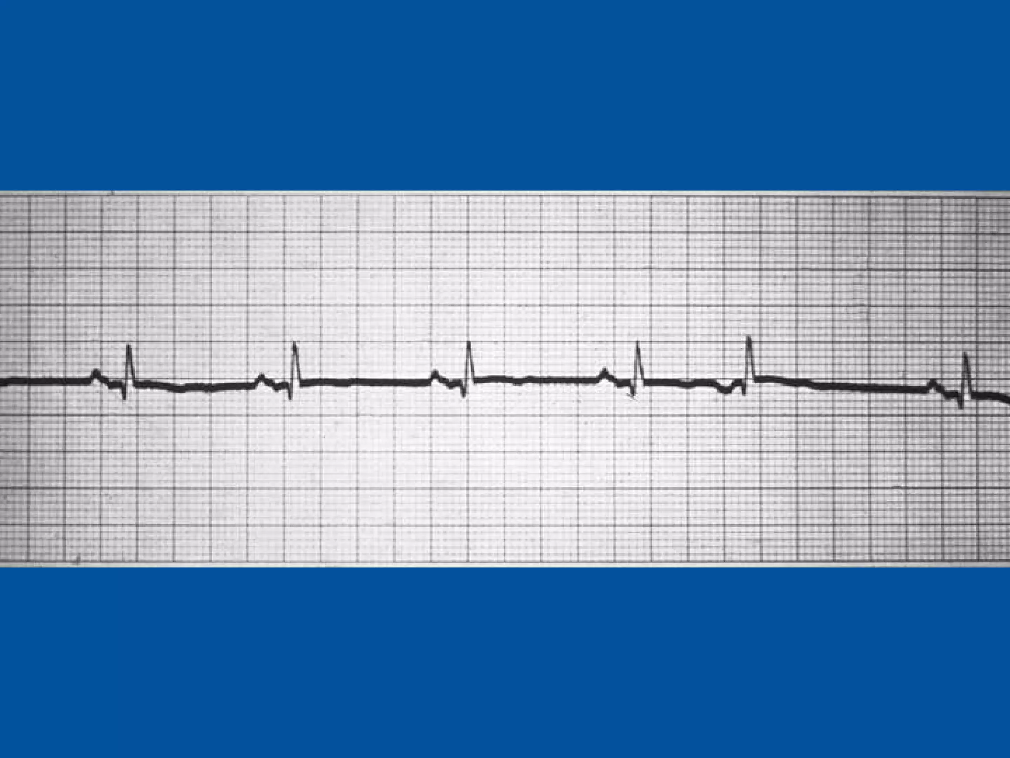 Basic ecg stripsnew | PPT