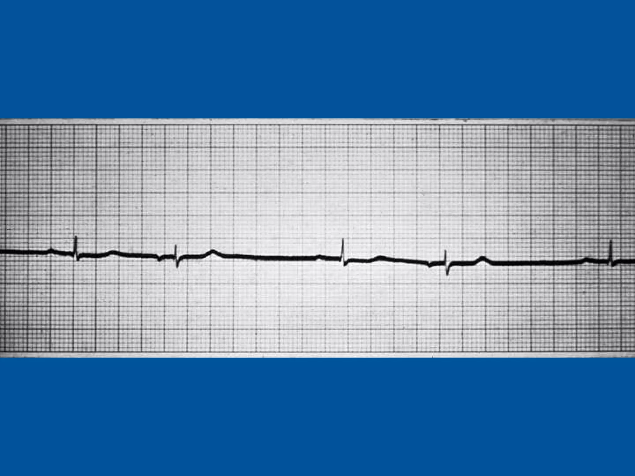 Basic ecg stripsnew | PPT