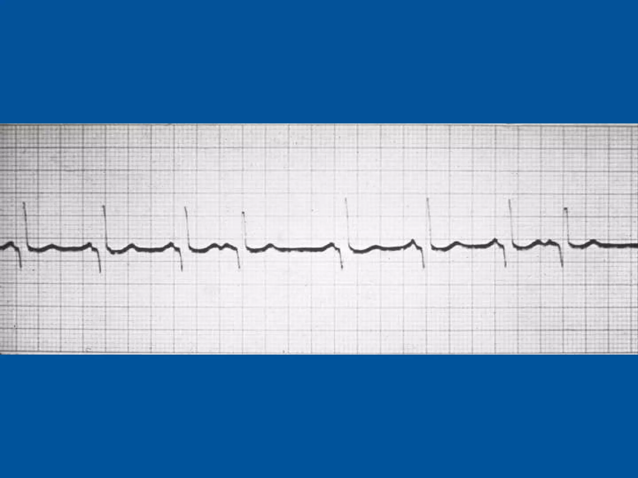 Basic ecg stripsnew | PPT