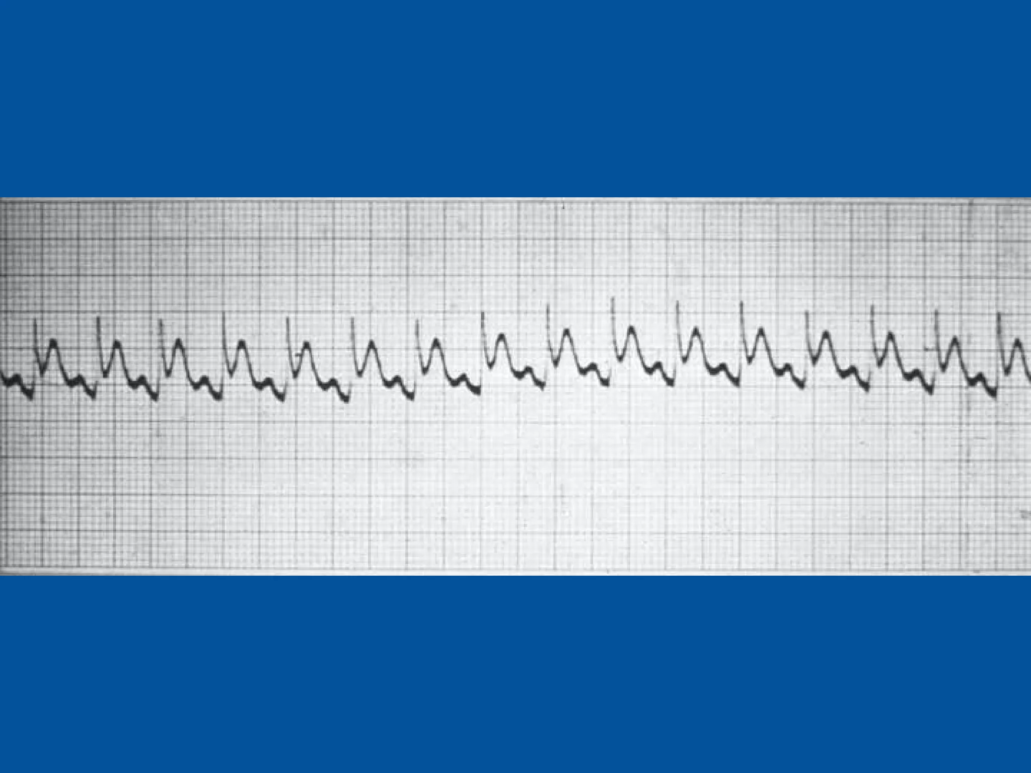 Basic ecg stripsnew | PPT