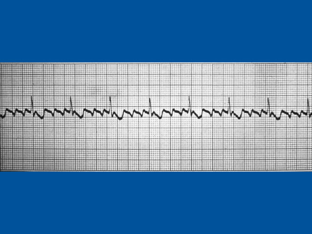 Basic ecg stripsnew | PPT