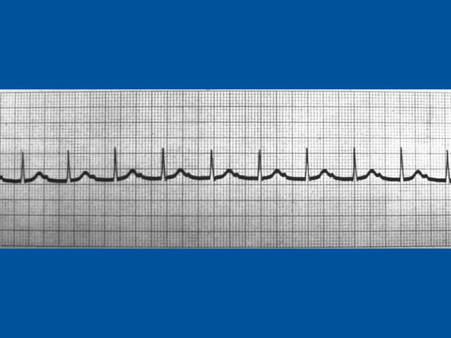 Basic ecg stripsnew | PPT