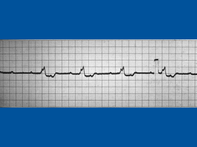 Basic ecg stripsnew | PPT