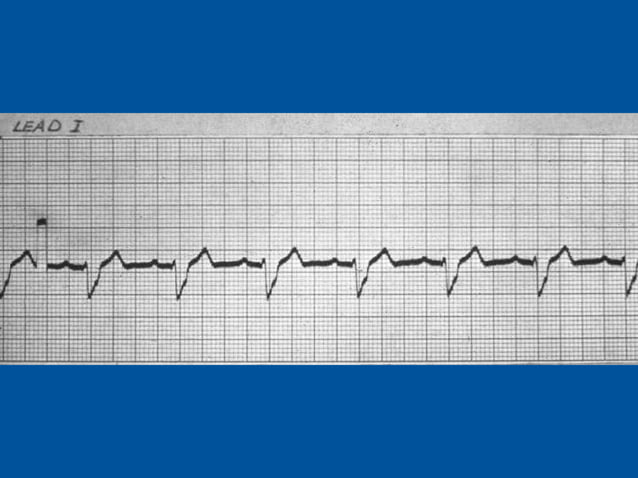 Basic ecg stripsnew | PPT