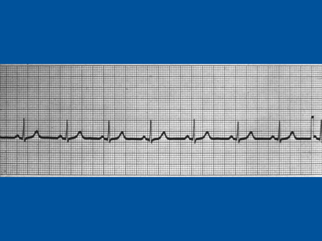 Basic ecg stripsnew | PPT