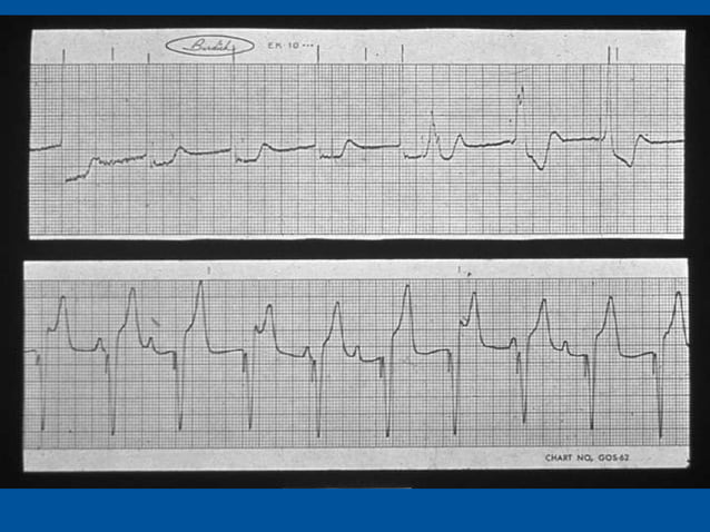 Basic ecg stripsnew | PPT