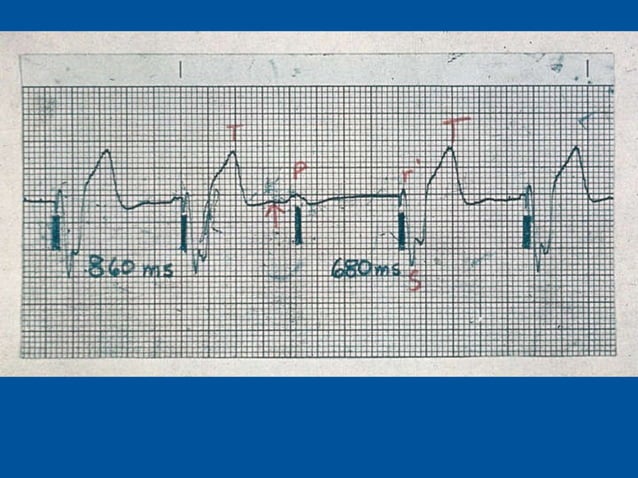 Basic ecg stripsnew | PPT