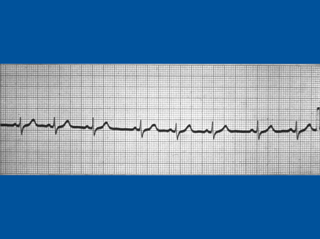 Basic ecg stripsnew | PPT