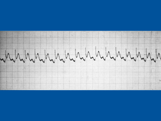 Basic ecg stripsnew | PPT