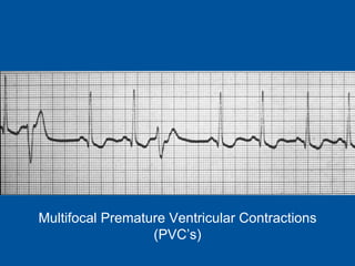 Multifocal Premature Ventricular Contractions