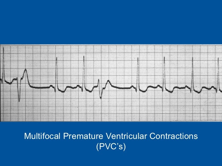 Multifocal Premature Ventricular Contractions Multifocal Atrial