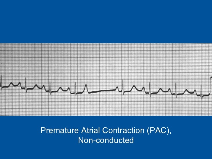Basic ecg stripsnew