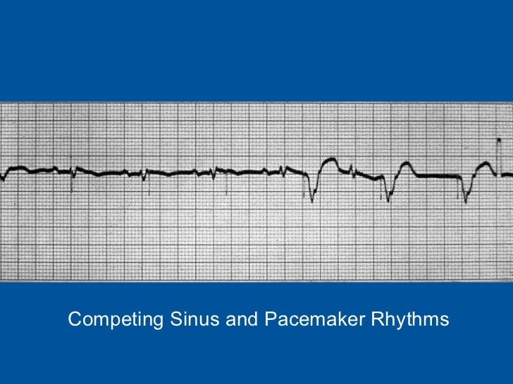 Basic ecg stripsnew