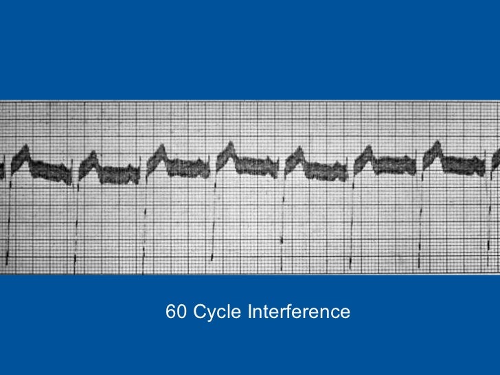 Basic ecg stripsnew