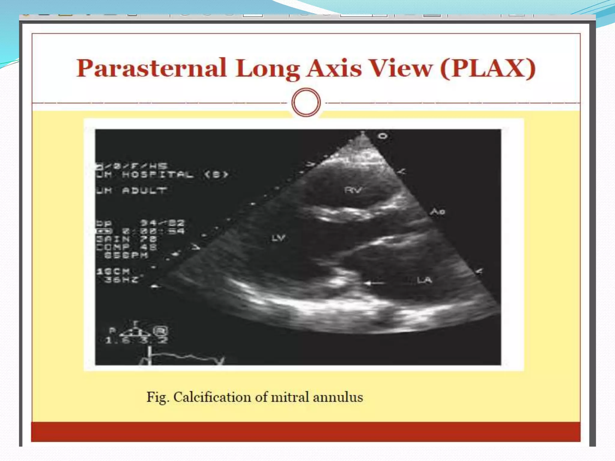 Basic echocardiography | PPTX
