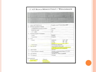 Basic EKG Interpretation | PPT