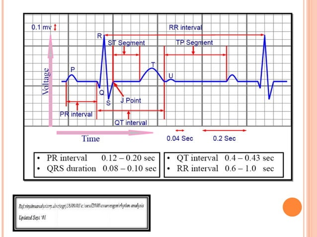 Basic EKG Interpretation | PPT