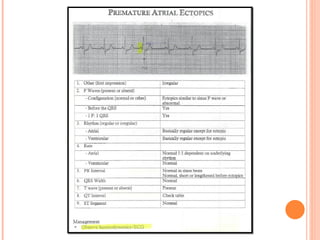 Basic EKG Interpretation | PPT