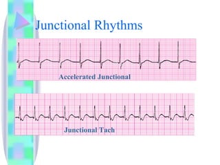 Basic Ekg Reviewr2 | PPT