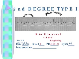 Basic Ekg Reviewr2 | PPT
