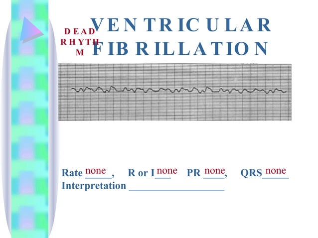 Basic Ekg Reviewr2 | PPT | Heart and Cardiovascular Diseases | Diseases and Conditions