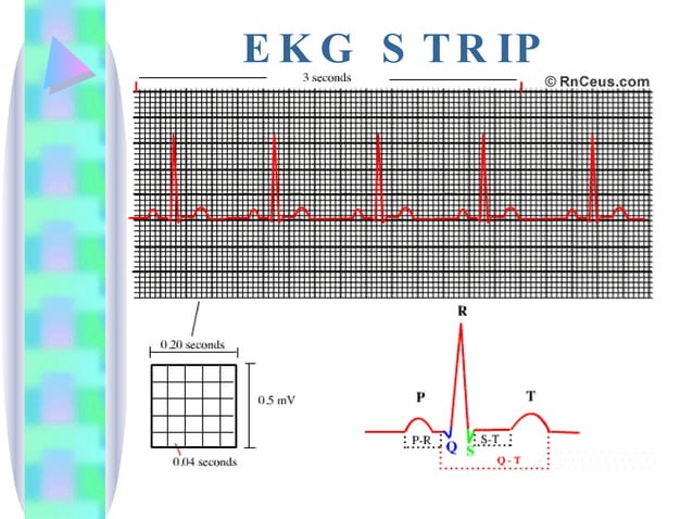Basic Ekg Reviewr2 | PPT | Heart and Cardiovascular Diseases | Diseases ...