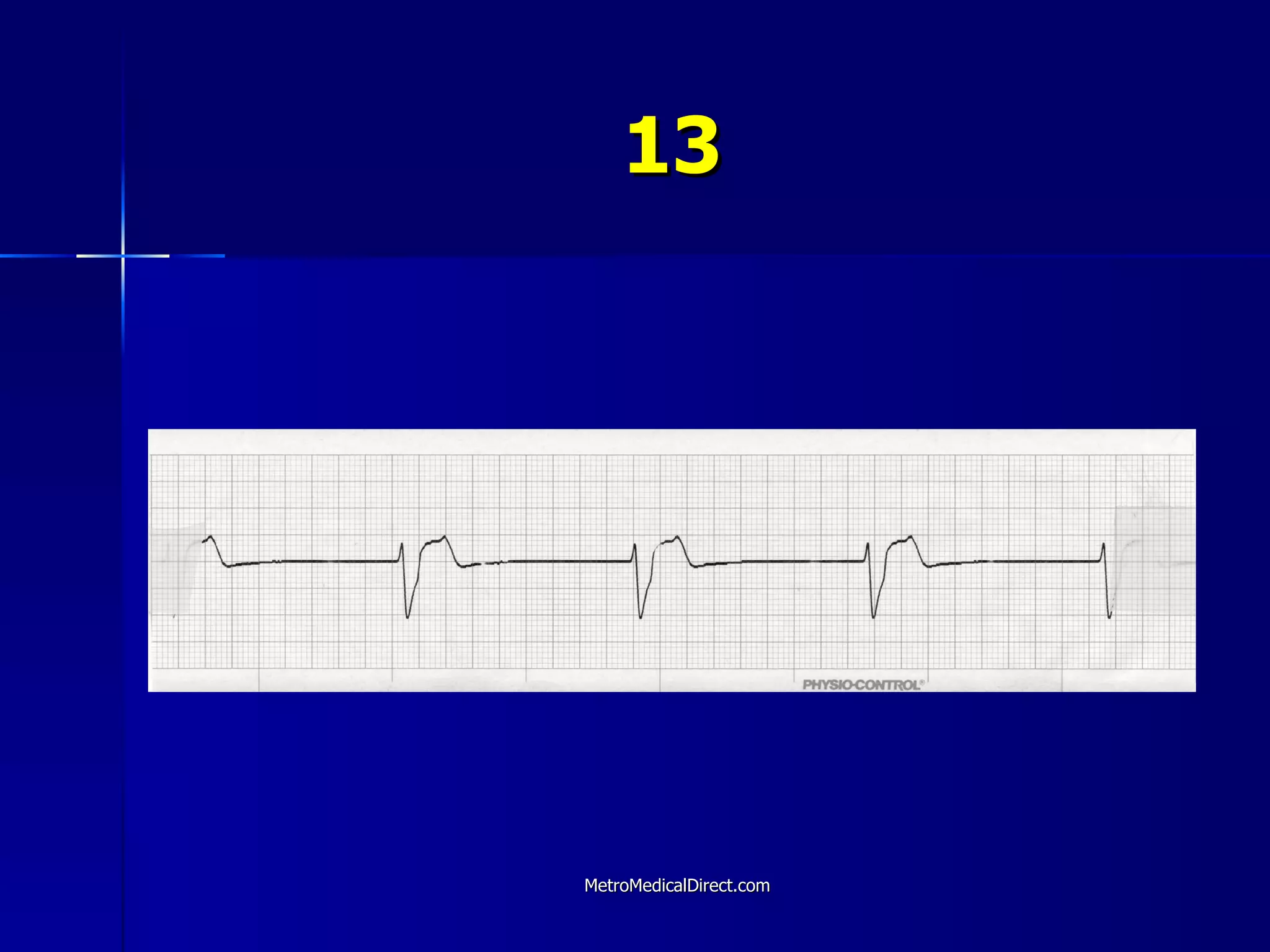 Basic EKG | PPT | Heart and Cardiovascular Diseases | Diseases and ...