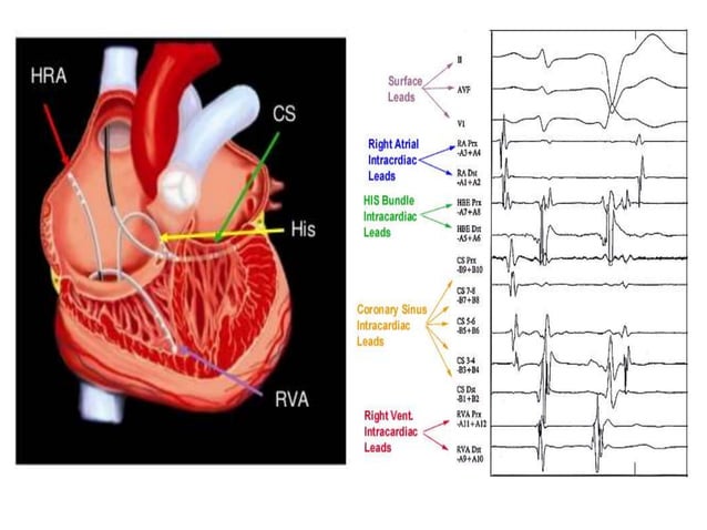 Basic electrocardiography and Beyond | PPT