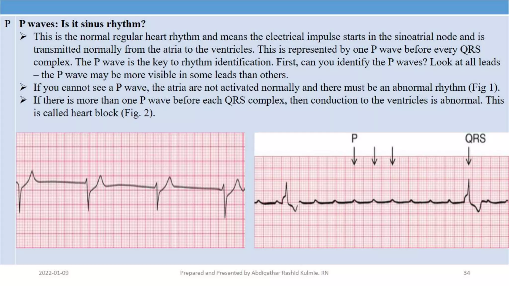 Basic electrophysiology, interpretation, cardiac monitoring and ...