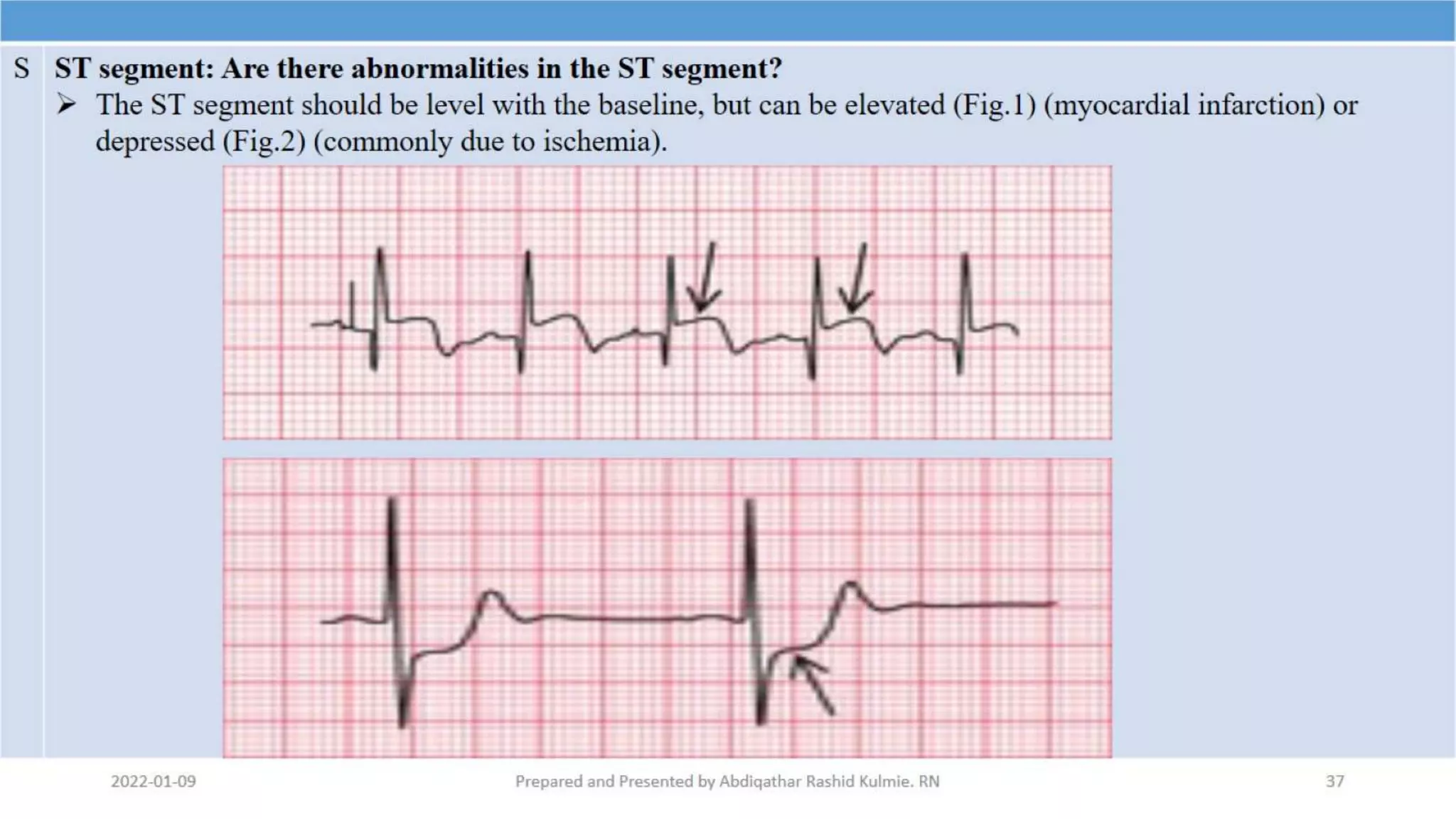 Basic electrophysiology, interpretation, cardiac monitoring and ...